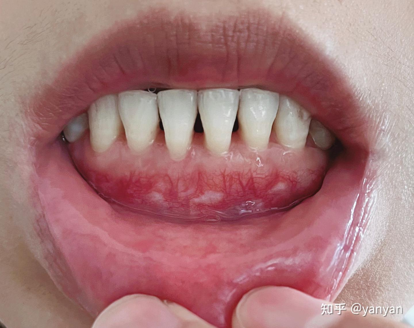 牙周膜龈手术+植骨（PAOO）记录 - 知乎