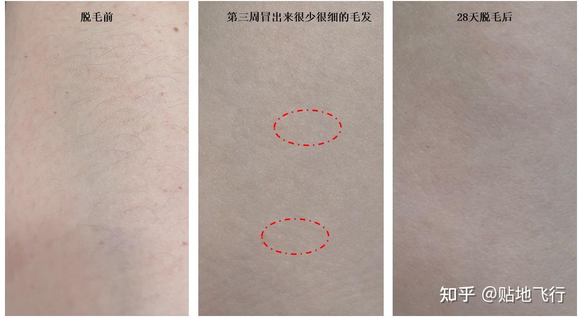 四大升级实现「长久脱毛」，论 Ulike 全新的 air3 到底有多卷？ - 知乎