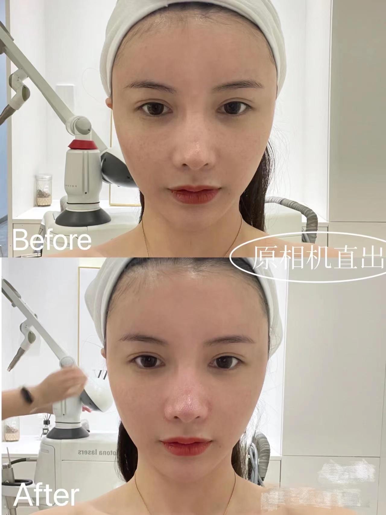 欧洲之星Fotona 4D Pro 4个模式详细介绍 - 知乎