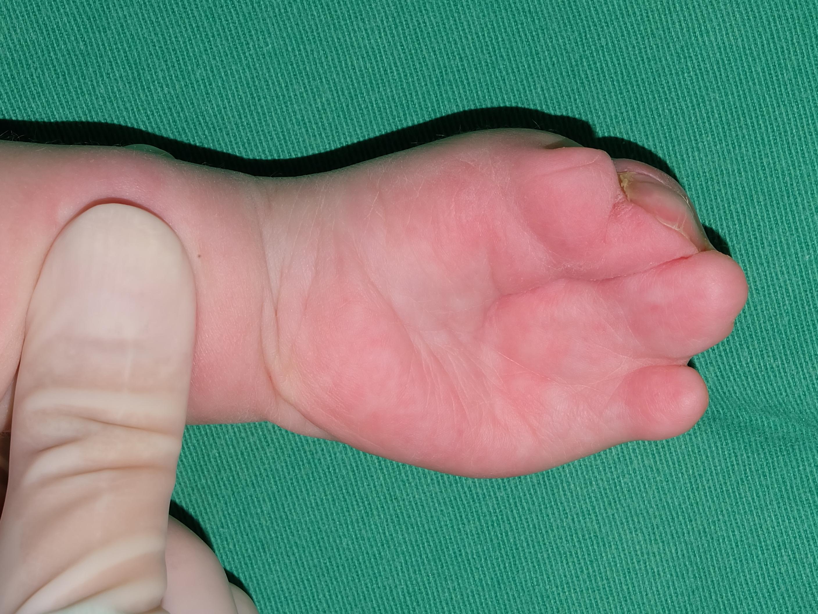 Apert综合征 - 知乎