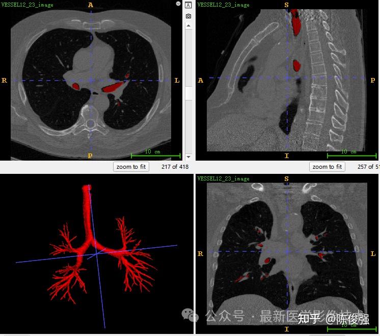 VESSEL2012——肺血管分割 - 知乎