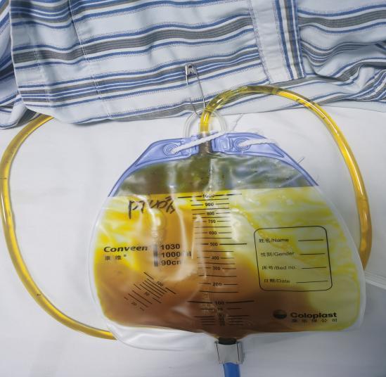 ptcd管脱落，什么情况下才能进行再次穿刺呢？ - 知乎