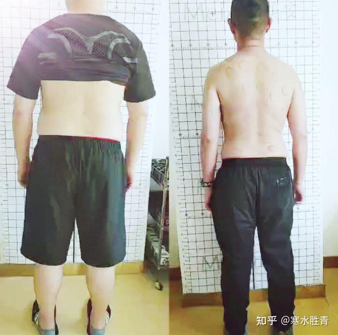 女生有了生长纹和肥胖纹自卑怎么办 知乎