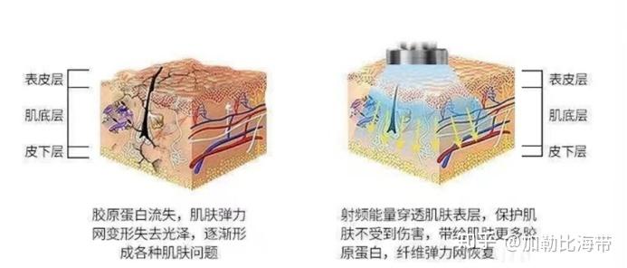 射频美容仪是智商税吗？DLUS射频美容仪全方位测评来了！ - 知乎