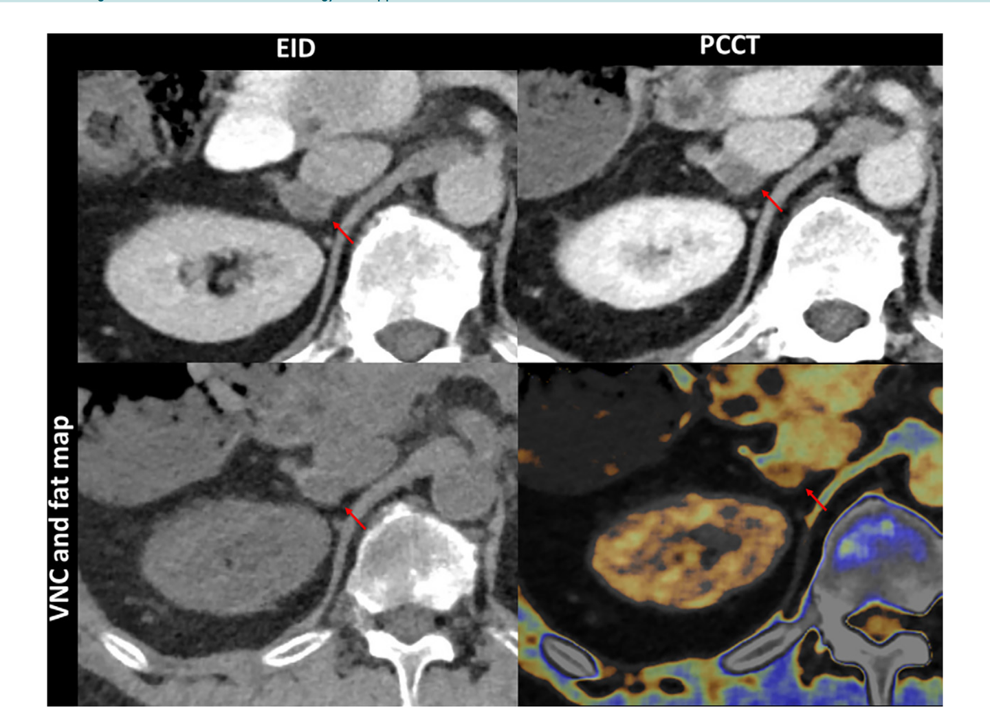 CT技术革命？一文读懂光子计数CT（PCCT）的前沿进展与临床潜力 - 知乎