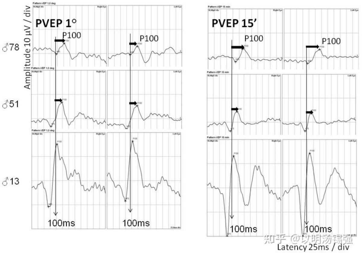 弱视眼视力已达标，但PVEP有异常 - 知乎