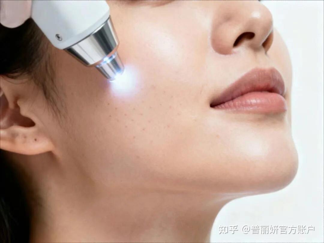 普丽妍PLLA 微球联合点阵 CO₂激光：痤疮萎缩性瘢痕治疗的创新突破 - 知乎