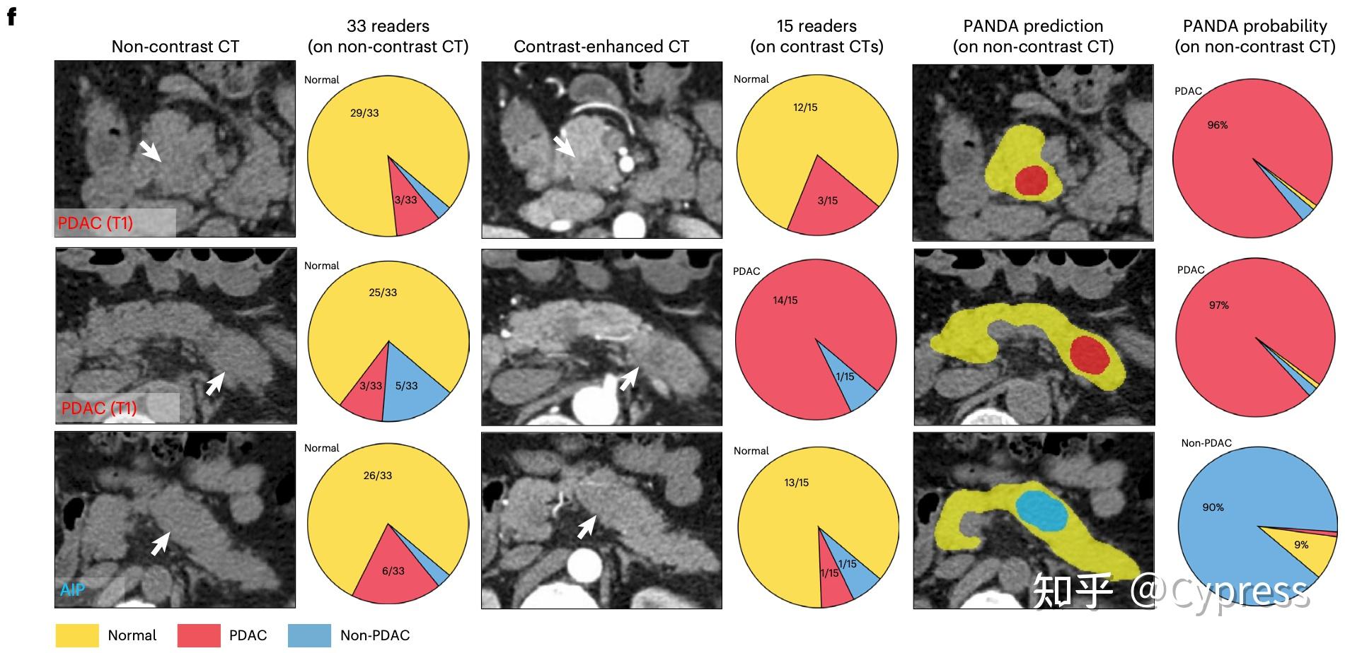 Large-scale pancreatic cancer detection via non-contrast CT and deep ...