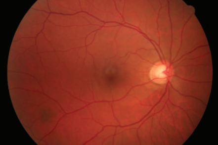 HRF 数据集介绍 - 知乎