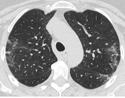 SARS-COV-2 Ct-Scan 数据集介绍 - 知乎