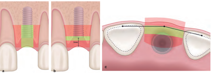 读书笔记|《30Years of Guided Bone Regeneration》 - 知乎