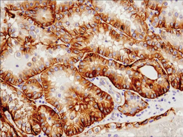 CDH6：卵巢癌靶向治疗新希望 - 知乎