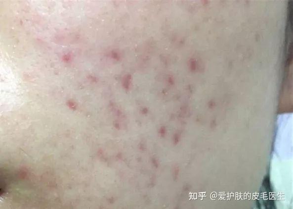常见护肤误区(三) 面膜到底需不需要每天都敷 长痘了能不能敷面膜” 知乎