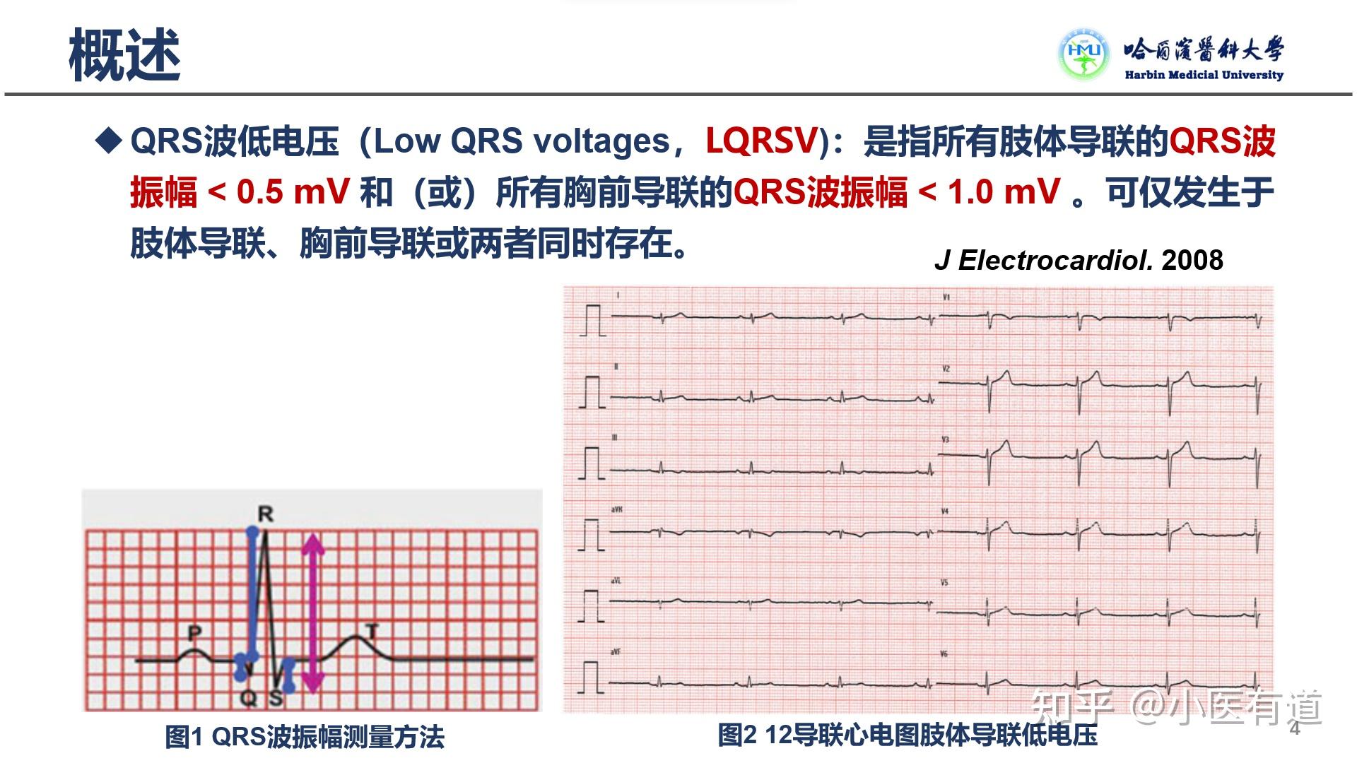 为什么心电图中T波与QRS波群的主波方向一致？ - 知乎
