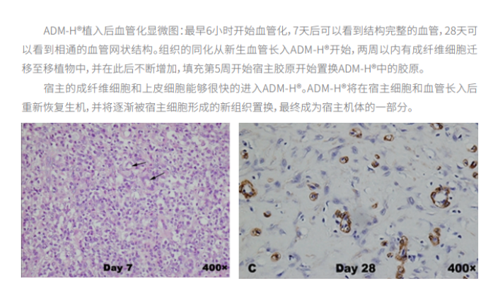 文献解读丨ADM-H紧缩术是目前微创紧缩术的主流方法 - 知乎