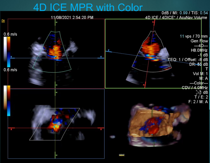 术中超声成像新技术|心腔内超声（ICE）②市场研发篇 - 知乎