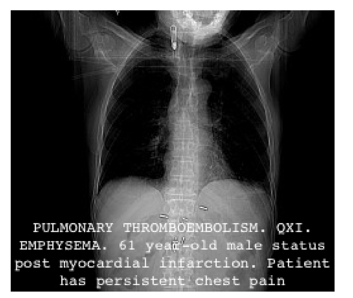 IU-Xray 印度大学胸部X线报告数据集介绍 - 知乎