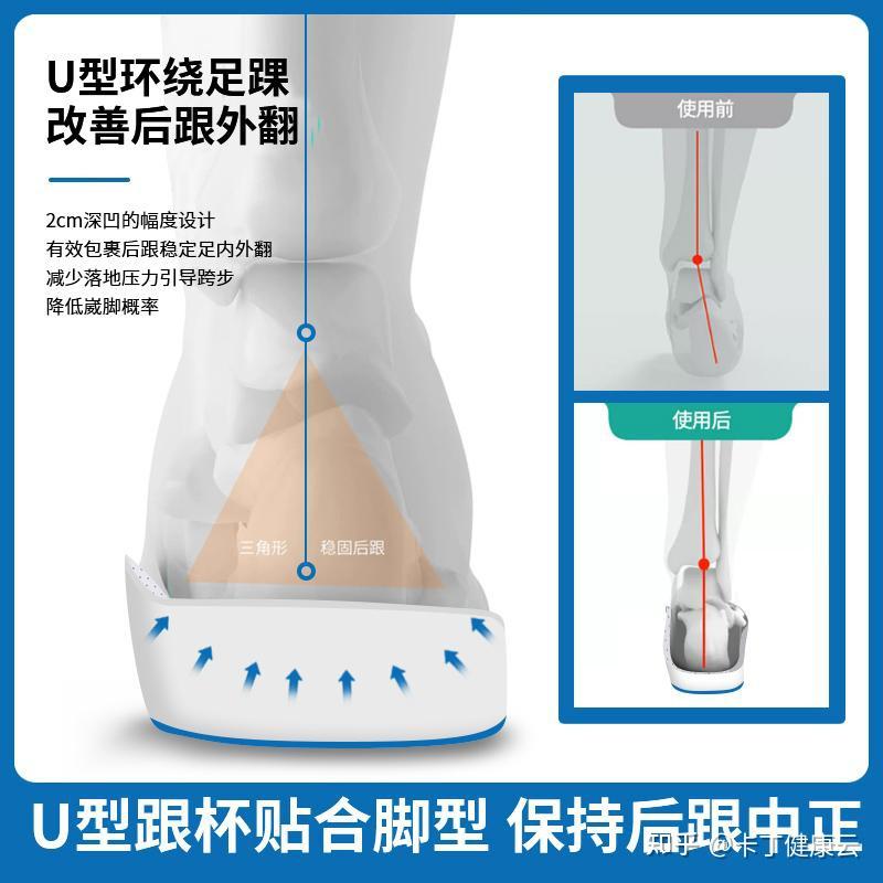 3D定制鞋垫是什么？扁平足、小腿外翻，试试3D定制鞋垫有用！ - 知乎