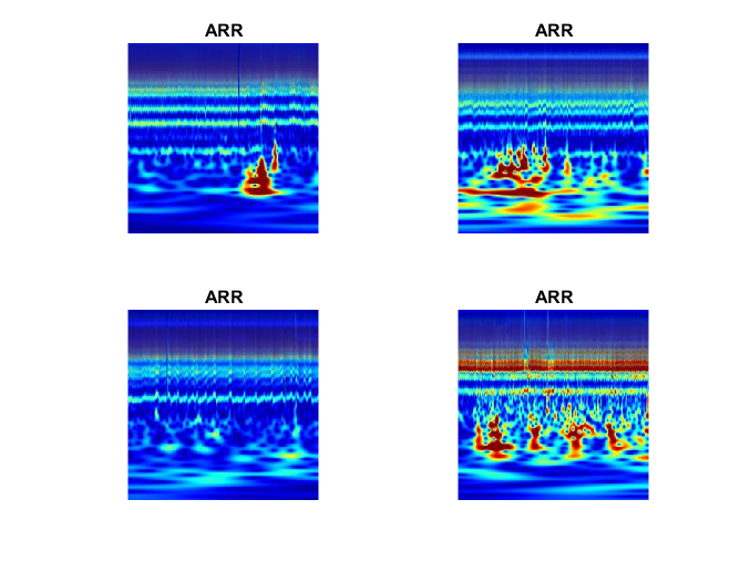 基于深度学习的心电信号（ECG）识别（MATLAB R2021B） - 知乎