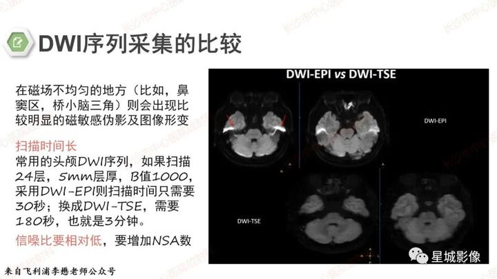 DWI序列判读原则及临床应用 - 知乎
