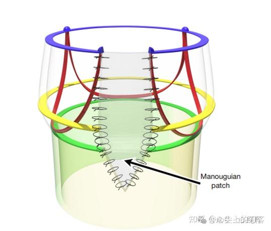 主动脉根部解剖：对主动脉瓣环和根部扩大技术的见解 - 知乎
