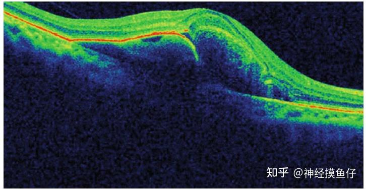 Chen et al. (2019) Retinal OCT Image Analysis 学习笔记 - 知乎