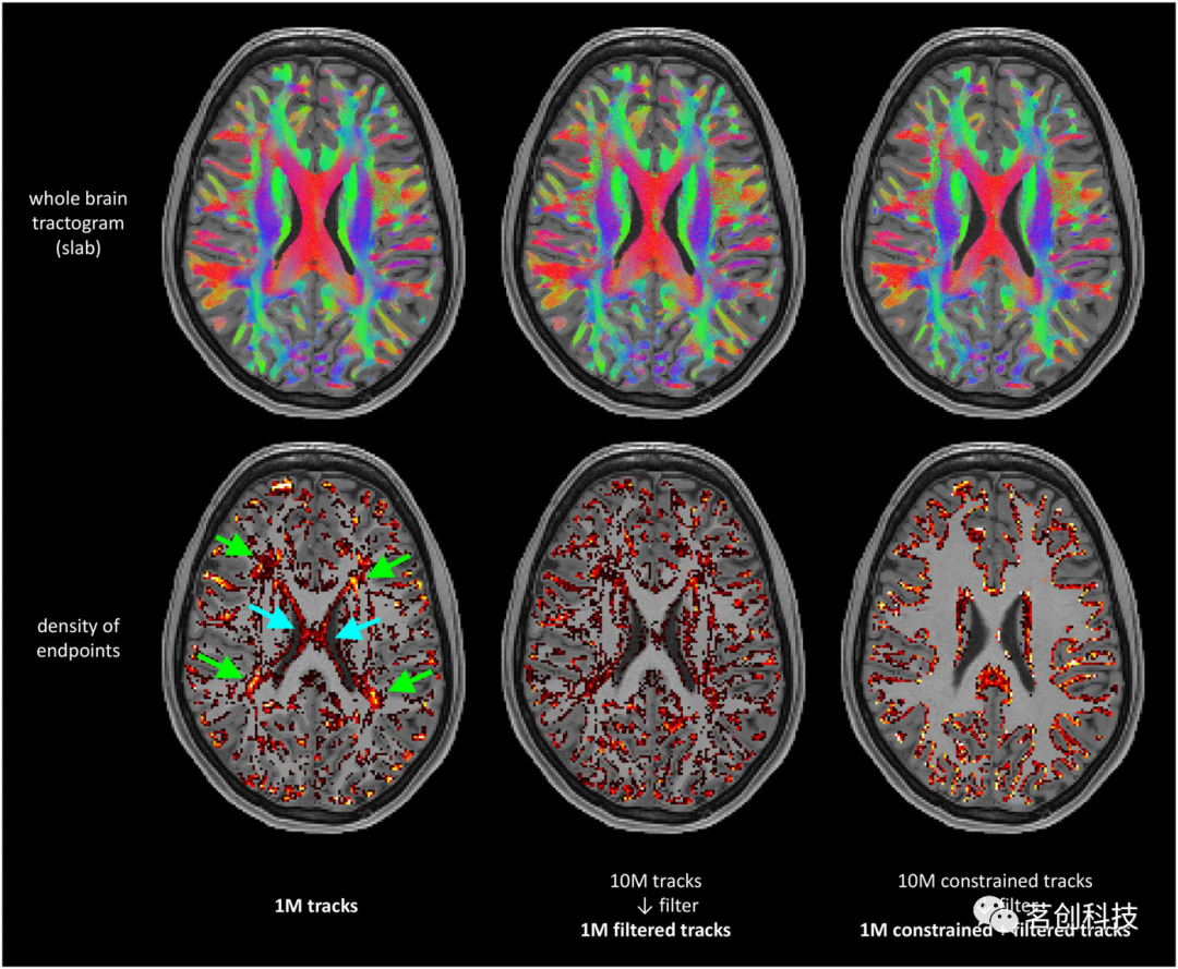 大脑弥散MRI纤维束成像 - 知乎