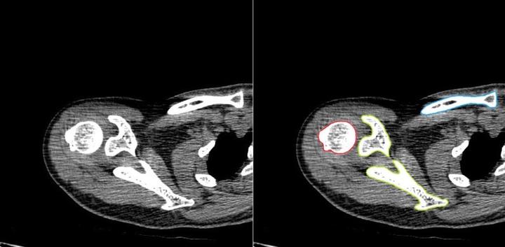 Fractured bone detection challenge CT 图像骨折分类数据集介绍 - 知乎