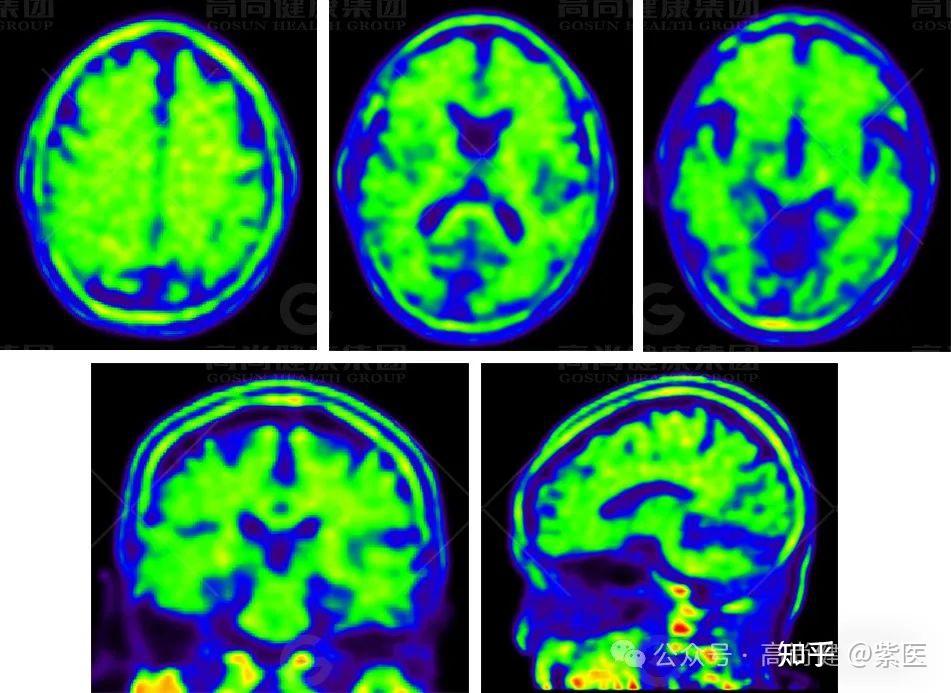 学术荟萃系列专题 | PET脑成像在阿尔茨海默病的应用价值 - 知乎
