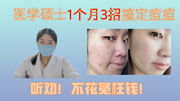 【长痘人群必看祛痘指南，听劝不花冤枉钱！】医学硕士自用3步科学祛痘法，有手就会，1个月让你改头换面，重回”妈生脸 ！ 知乎