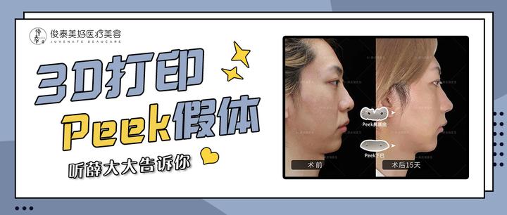 3D打印数字化定制丨Peek鼻基底+Peek下巴 - 知乎