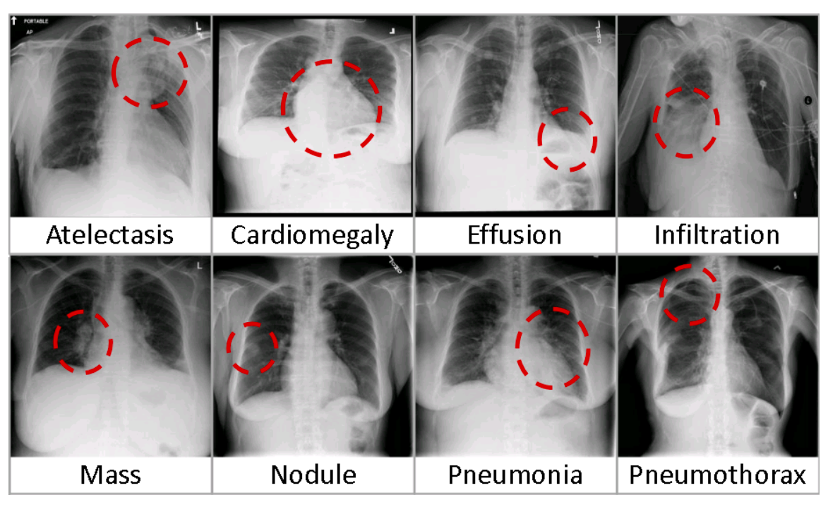 ChestX-ray8 数据集介绍 - 知乎