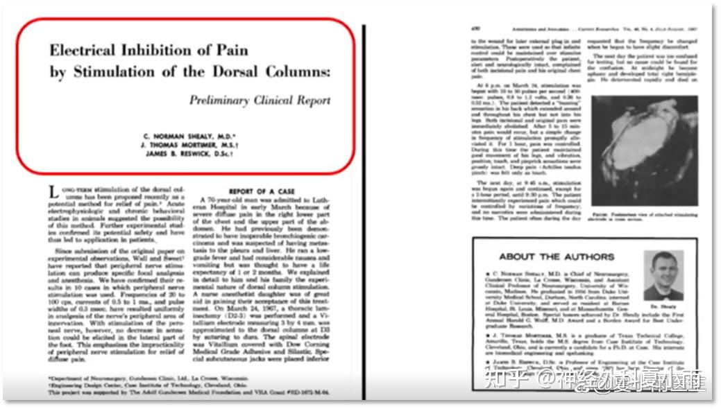 国内脊髓电刺激 (SCS) 神经调控治疗慢性疼痛的发展过程 - 知乎