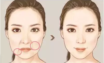 并不是所有人都适合埋线！！！PDO、PPDO、大V、小V都有什么区别？ - 知乎