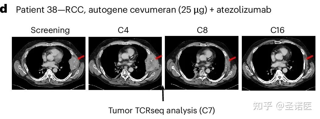 个体化mRNA癌症疫苗BNT122(Autogene Cevumeran、RO7198457)帮患者肿瘤缩小近10倍，多癌种晚期患者获益显著 - 知乎