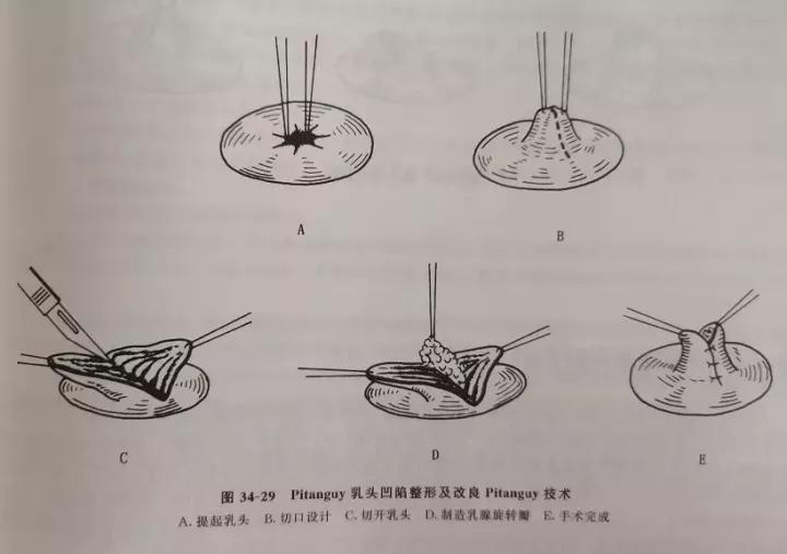 乳头凹陷怎么办？教你乳头塑形的正确步骤！ 知乎