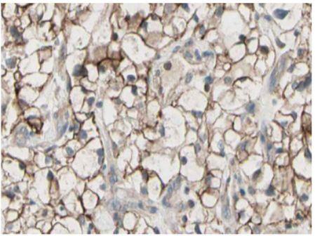CDH6：卵巢癌靶向治疗新希望 - 知乎