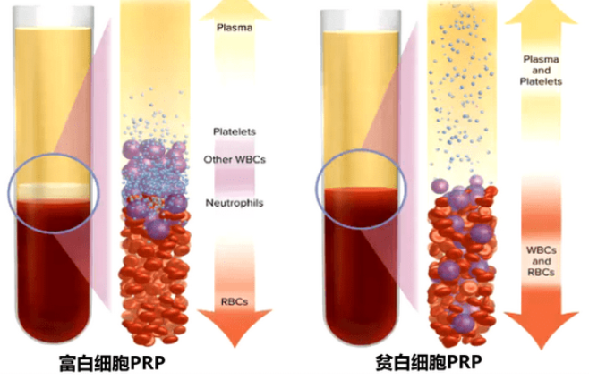 PRP在膝关节常见疾病中的临床应用 - 知乎