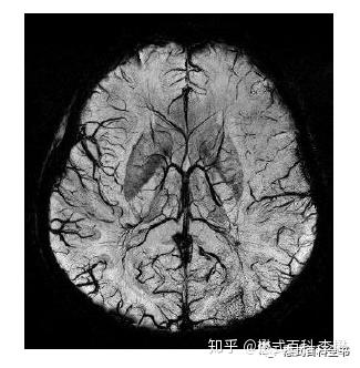 SWI序列原理及临床应用 - 知乎