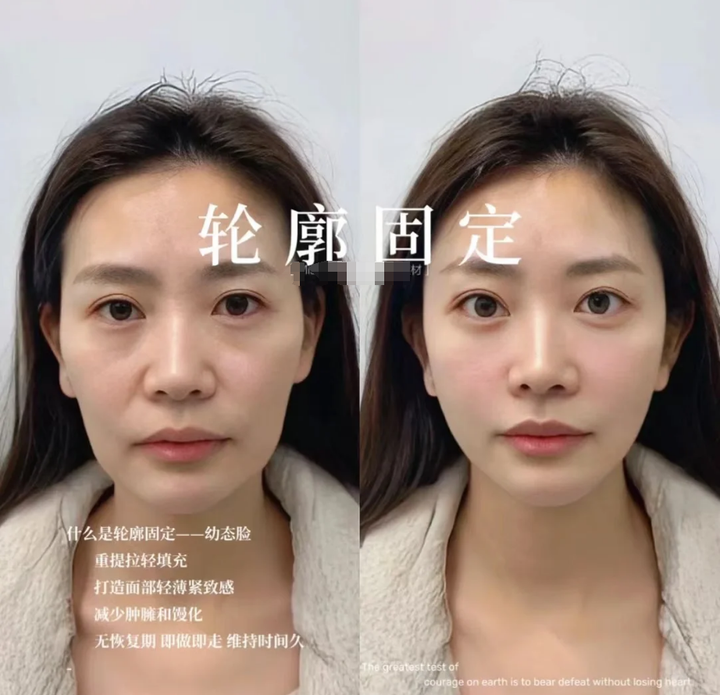 什么样的脸形适合做轮廓固定?——邢台李学英健康科普 知乎