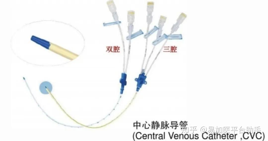 化疗置管选picc好还是cvc好？ - 知乎