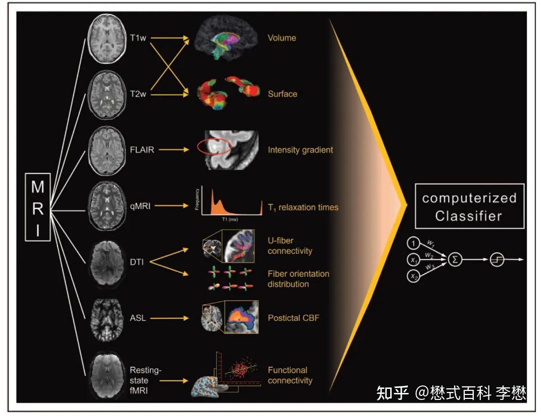 癫痫MRI扫描方案 - 知乎