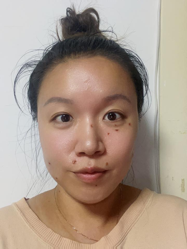 Day5：术后第四天，结大痂，翘边了 - 知乎