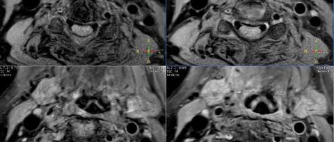 PSIR序列原理及临床应用 - 知乎
