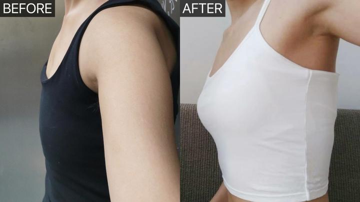 171cm/55kg江苏姑娘天生小胸,做完自体脂肪丰胸,终于说出了真相! - 知乎