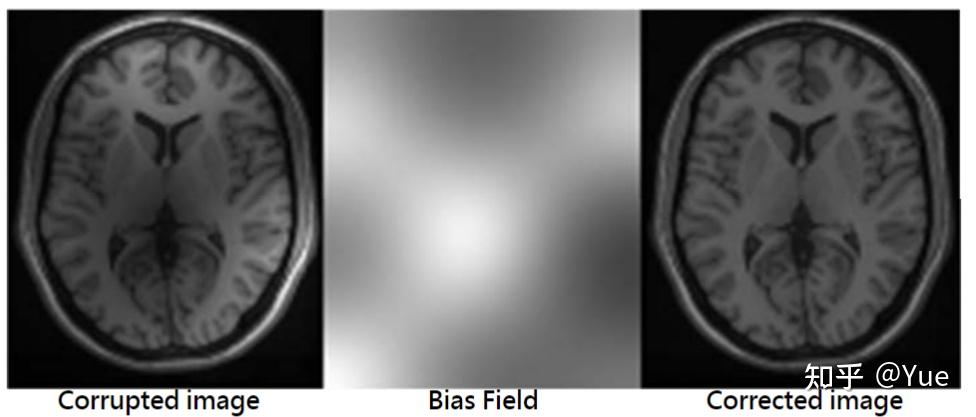 00_医学影像学习_MRI_VBM - 知乎