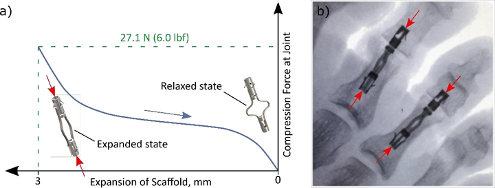 SUPERSCAFFOLD™ -ANOVEL 镍钛诺骨传导支架和指间融合装置SAES Smart Materials - 知乎