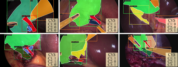 Endoscapes 数据集介绍 - 知乎