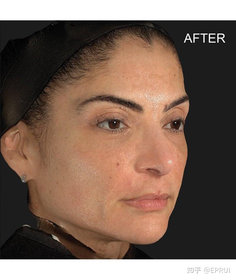 25-45um 医美用CaHA羟基磷灰石微球 - 知乎