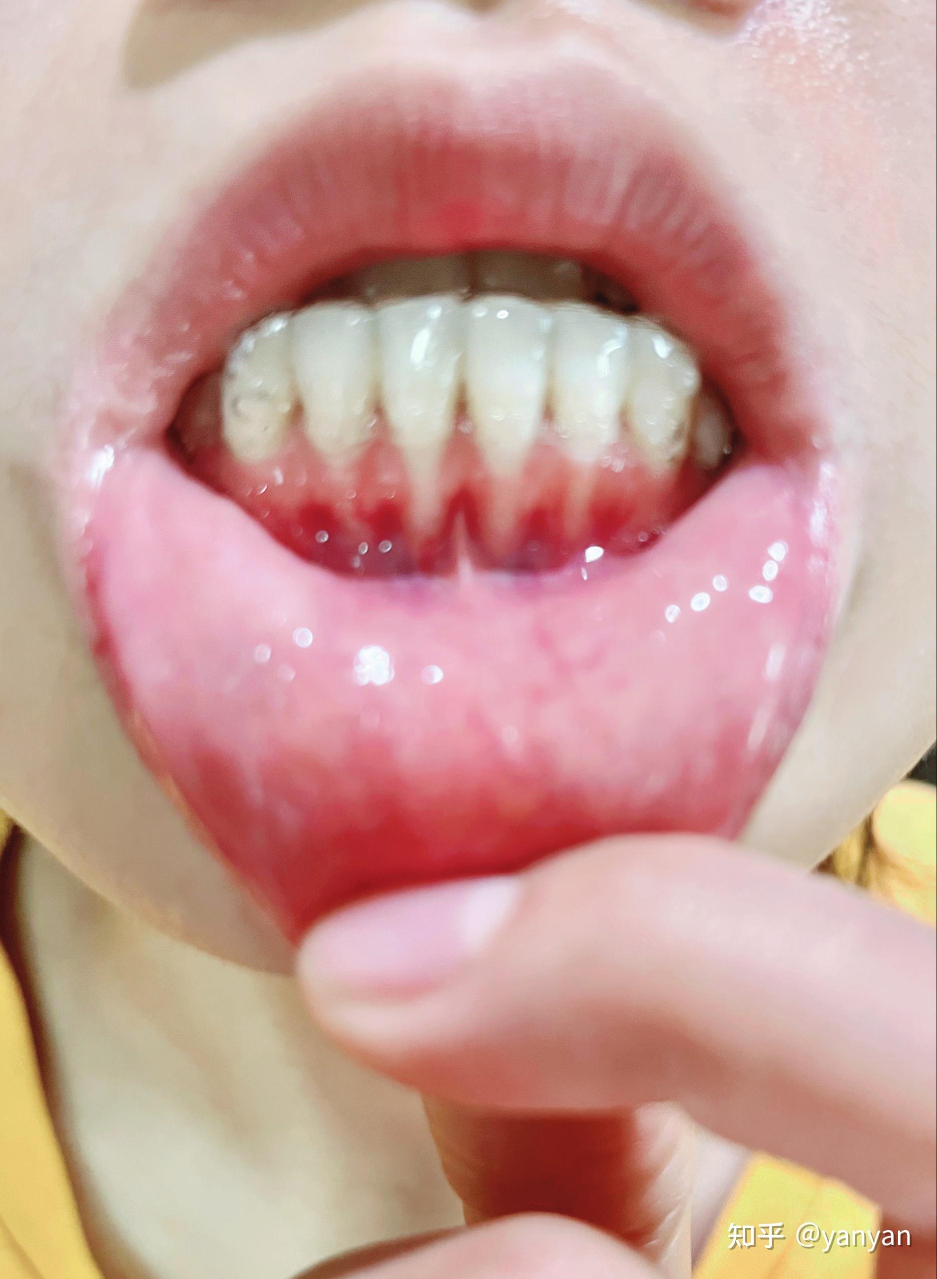 牙周膜龈手术+植骨（PAOO）记录 - 知乎